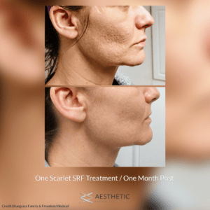 Scarlet SRF Microneedling - Medical Spa in Montgomery, AL