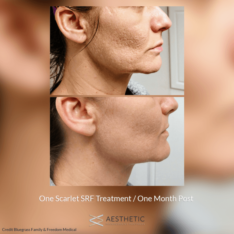 Scarlet SRF Microneedling - Medical Spa in Montgomery, AL