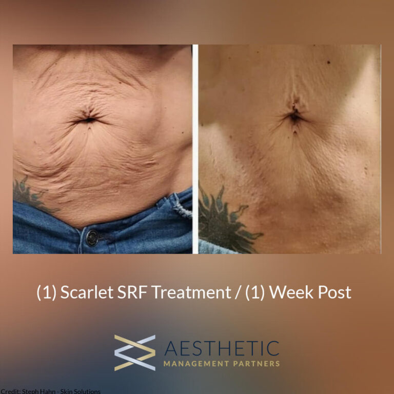 Scarlet SRF Microneedling - Medical Spa in Montgomery, AL